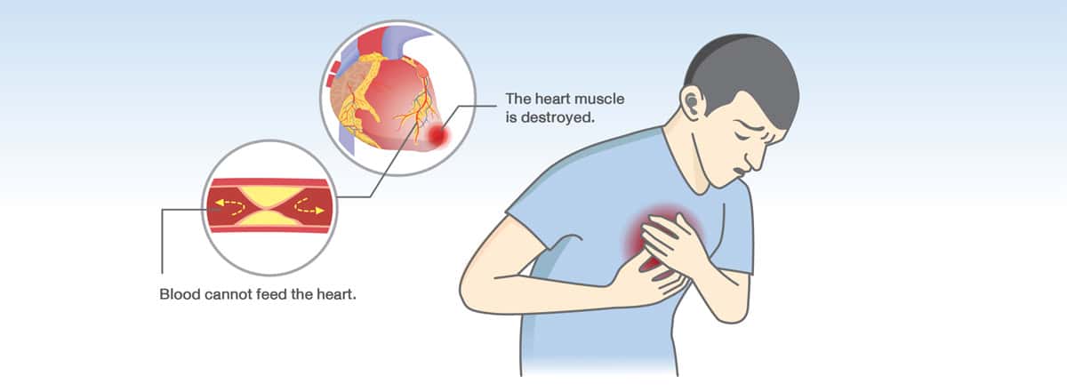 Result of Treatment for Patient with ST-segment Elevation Myocardial ...