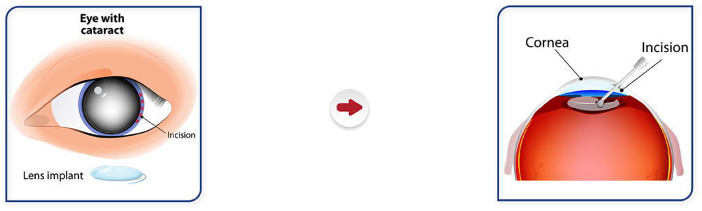 Clinical Outcomes of CATARACT treatment | Bangkok Hospital Phuket ...