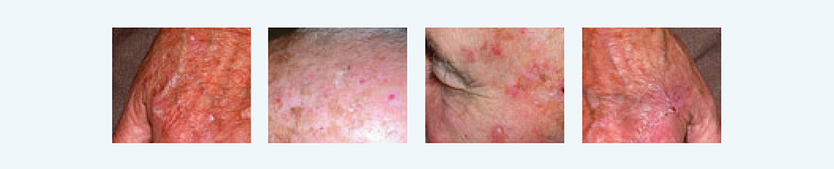 SKIN CANCER (HOW TO CHECK YOUR SKIN AND WHAT TO LOOK OUT FOR) | Bangkok ...