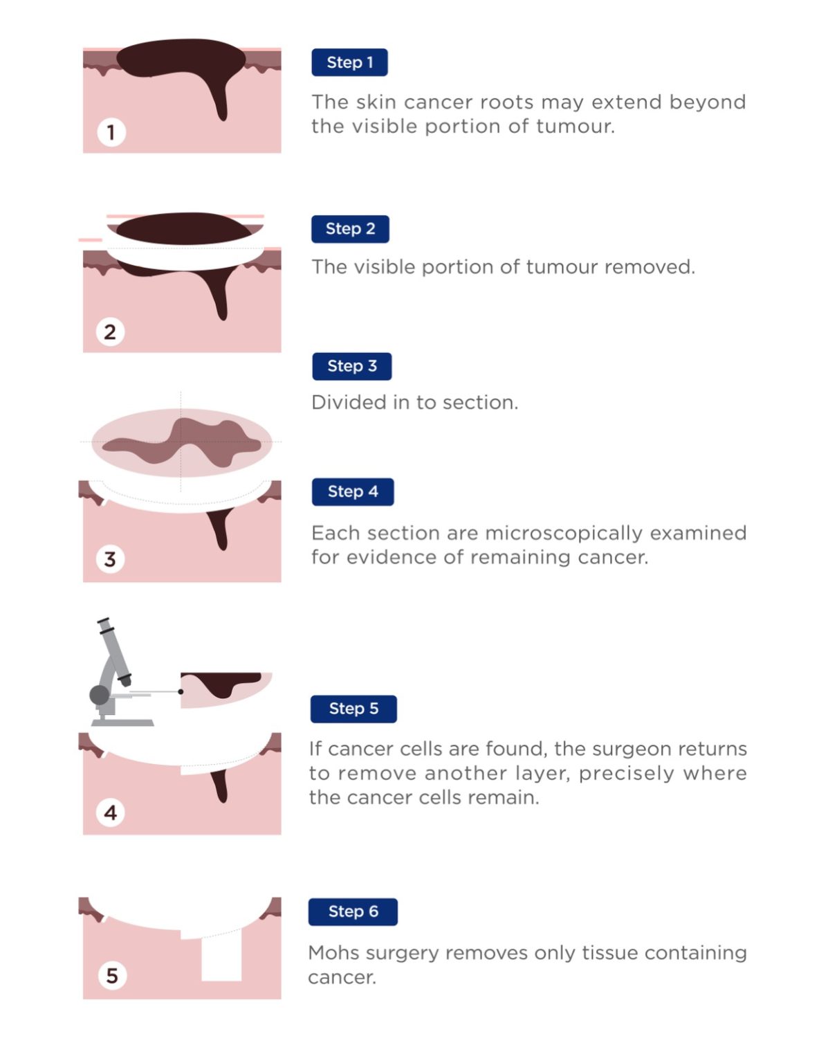 “Skin cancer : Mohs Micrographic Surgery” | Bangkok Hospital Phuket ...