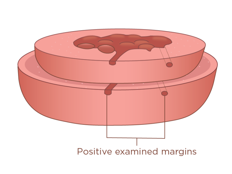 Mohs Surgery VS Wide Excision What are the differences? | Bangkok ...