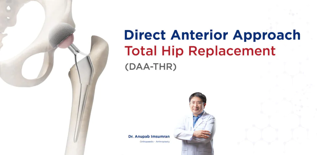 Direct Anterior Approach Total Hip Replacement (DAA-THR) | Bangkok Hospital Phuket ...