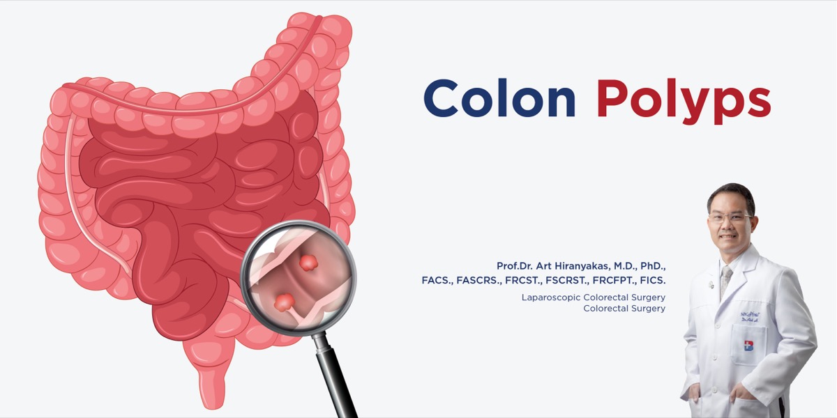 Colon Polyps | Bangkok Hospital Phuket – International Hospitals in ...