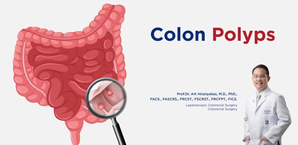 Colon Polyps | Bangkok Hospital Phuket – International Hospitals in ...